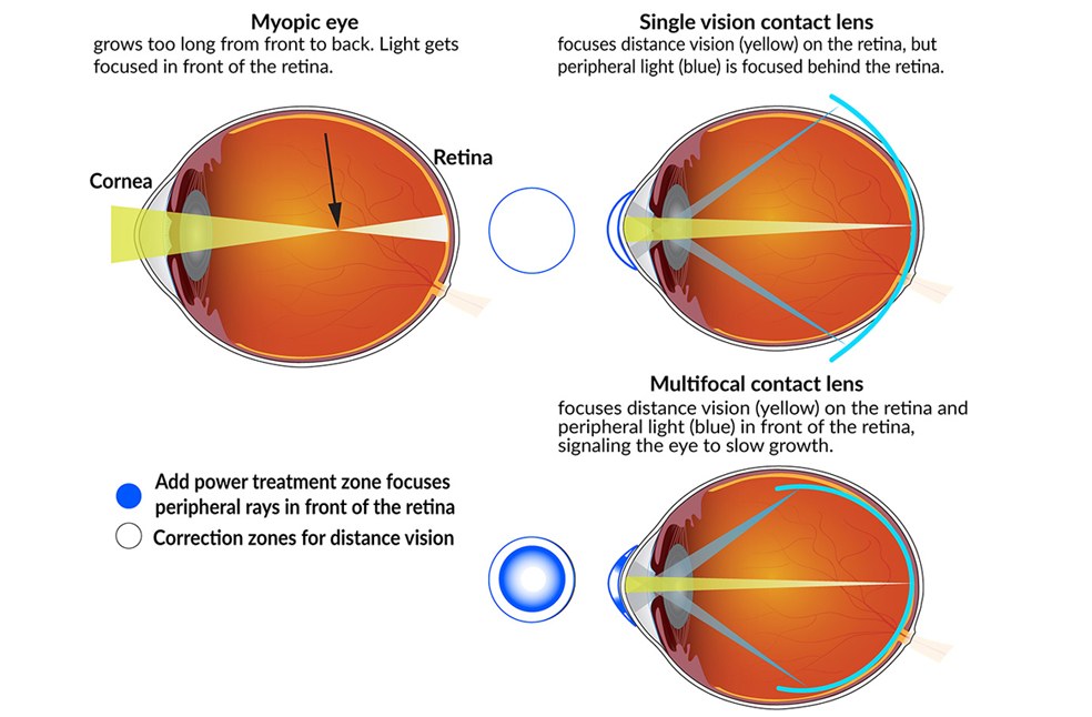 Myopia control lenses show long-term benefits; Study finds - Emirati Times